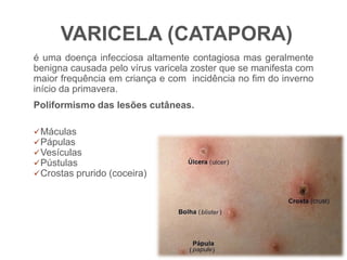 VAricela.pdf