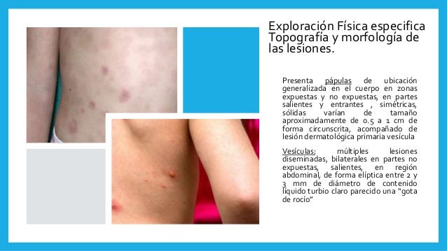 Varicela Caso clínico