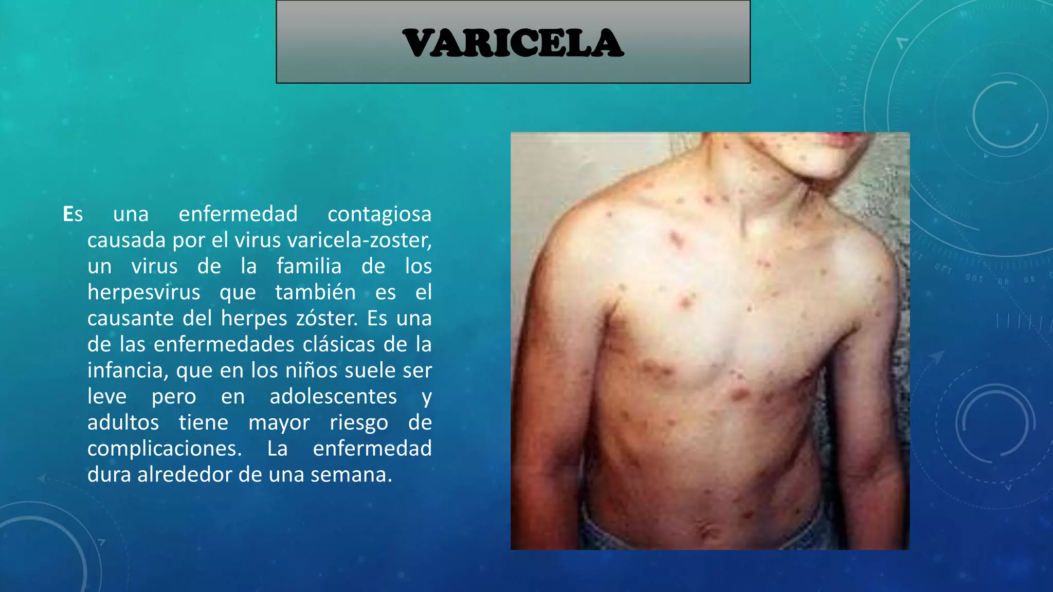 Varicela y herpes zoster | PPT