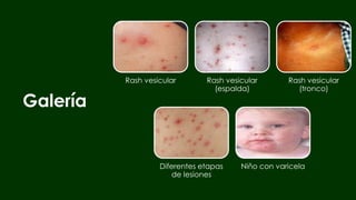 Varicela y sarampión | PPTX