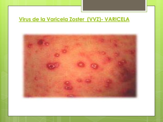 Varicela zoster | PPTX
