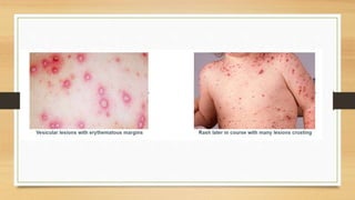 Varicella-Zoster Viral Infection.pptx