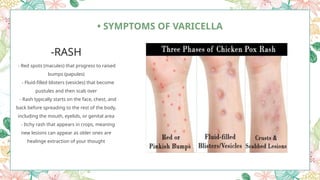 VARICELLA2.pptx ayurveda herbal plant BAMS | PPTX