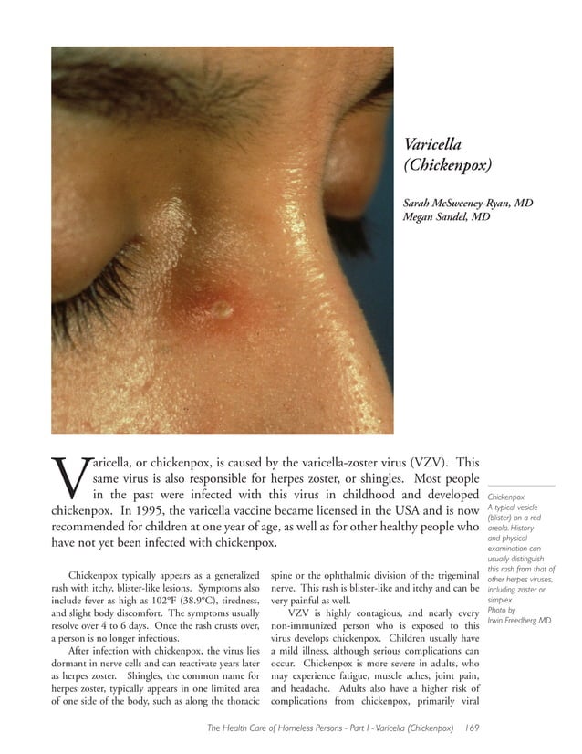 Varicella chickenpox | PDF