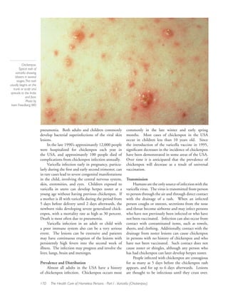 Varicella chickenpox | PDF