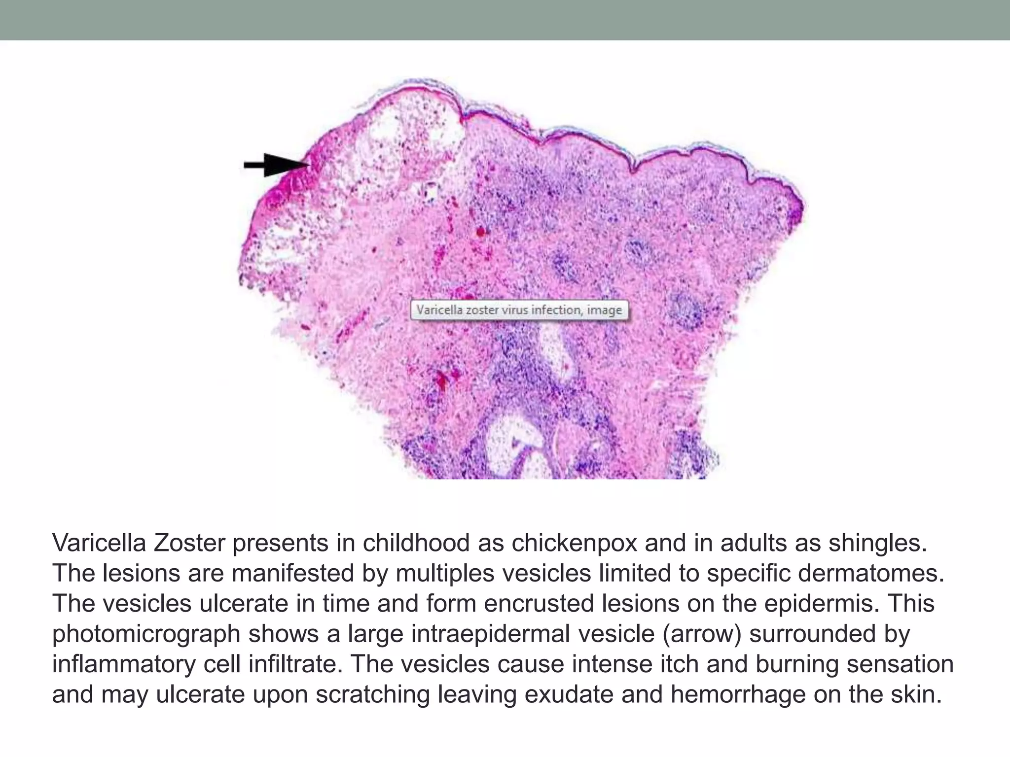 Infeksi Varicella Zoster dan Rubella | PPT | Free Download