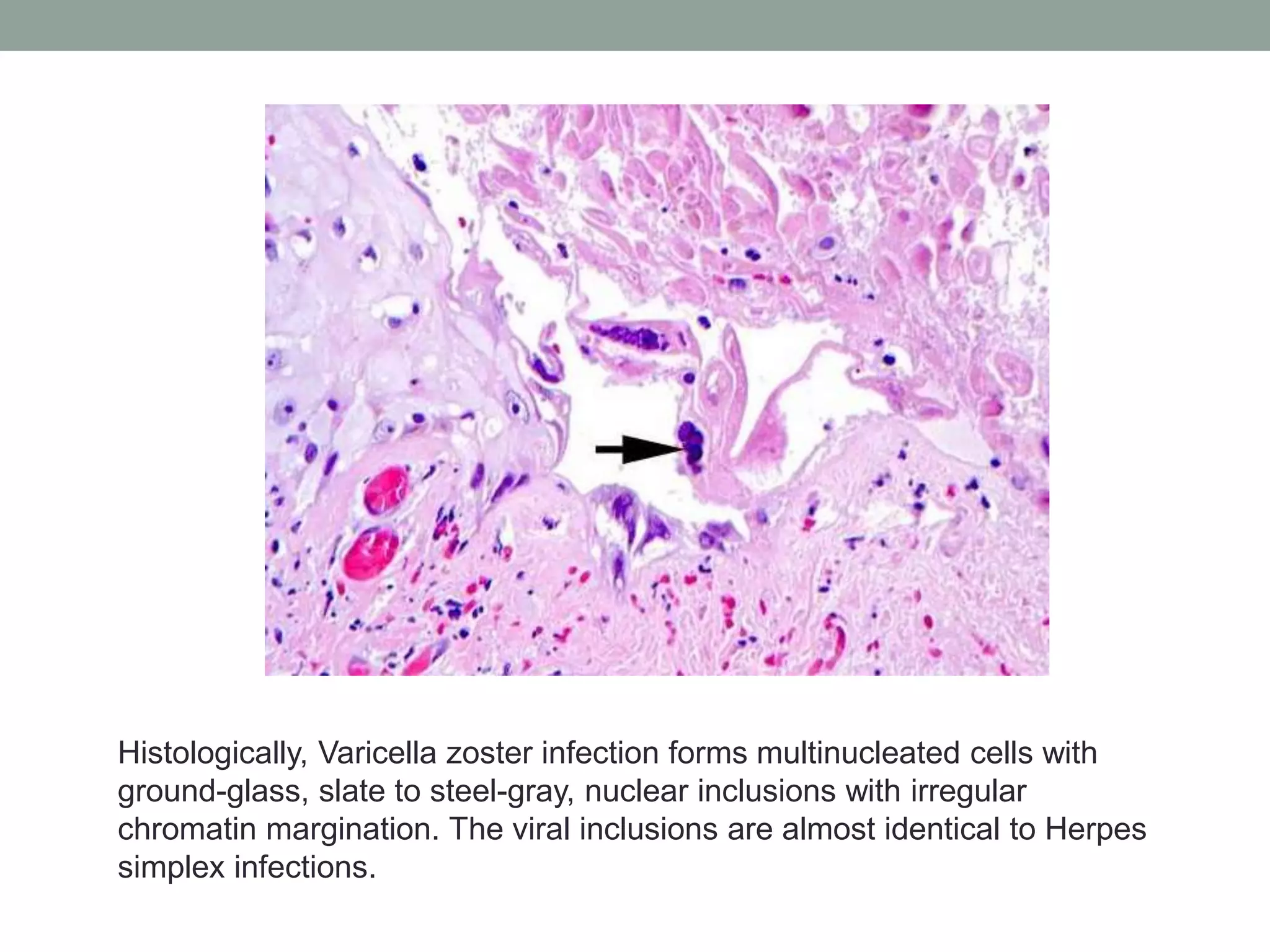 Infeksi Varicella Zoster dan Rubella | PPTX