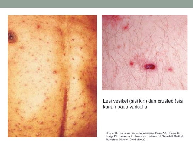 Infeksi Varicella Zoster dan Rubella | PPTX