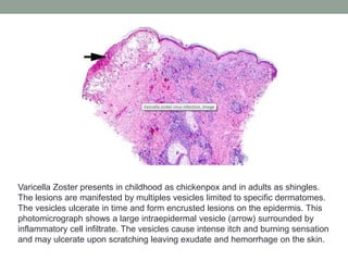 Infeksi Varicella Zoster dan Rubella | PPTX