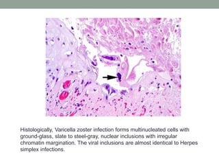 Infeksi Varicella Zoster dan Rubella | PPTX