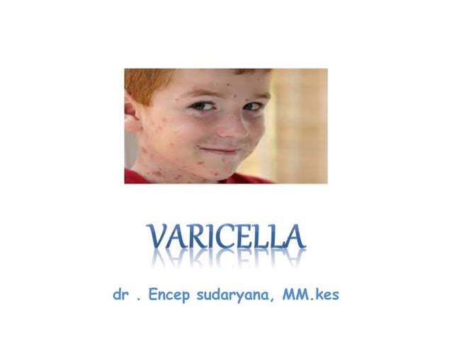 VARICELLA_ppt.pptxVARICELLA_ppt.pptxVARICELLA_ppt.pptx