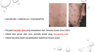 varicella zooster .ppt