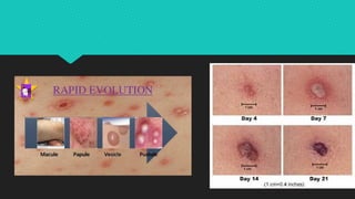 Varicella zoster Presentation (3).pptx.. | PPTX