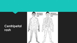 Varicella zoster Presentation (3).pptx.. | PPTX