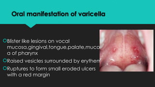 Varicella zoster Presentation (3).pptx.. | PPTX