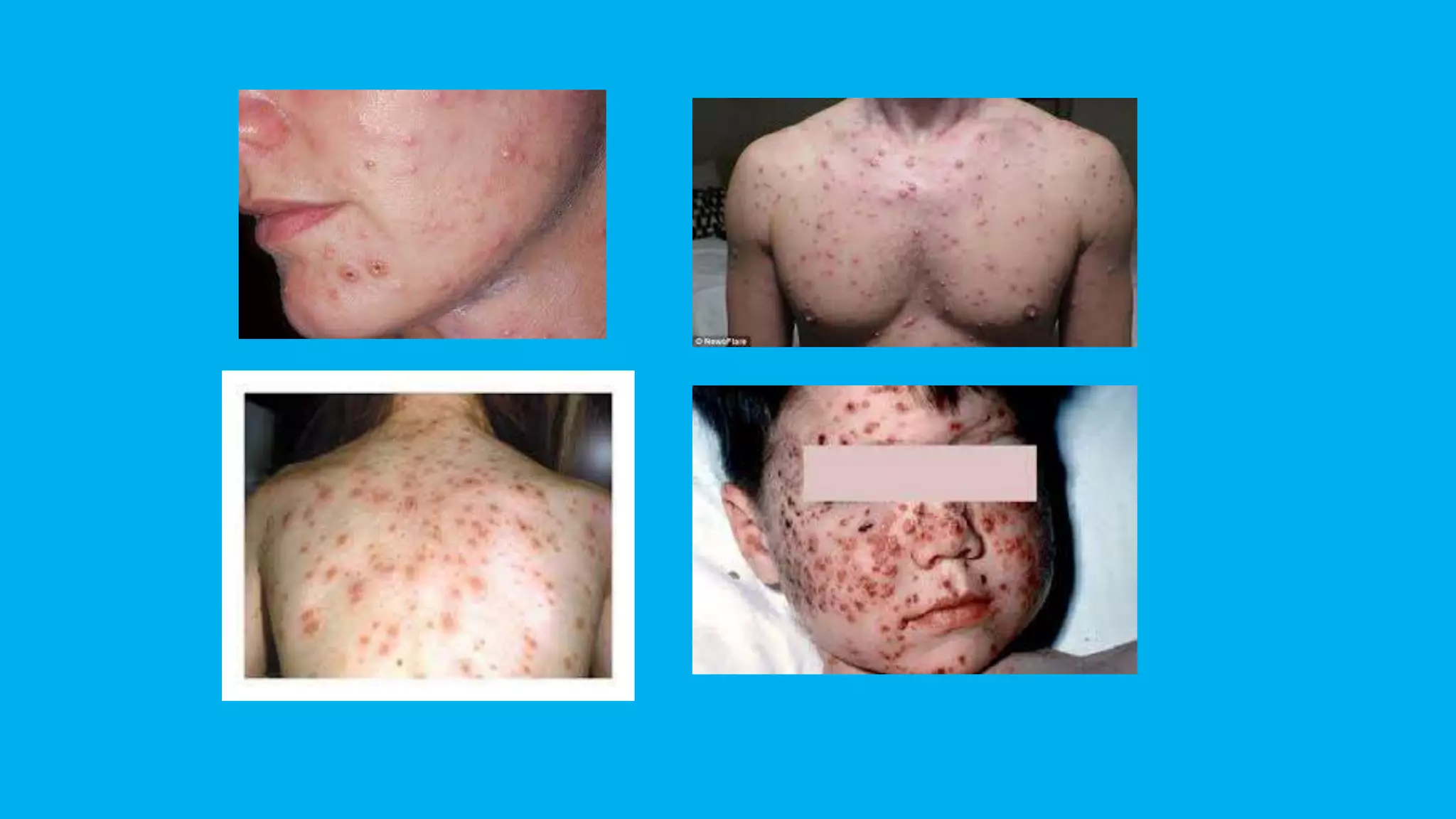 Varicella zoster virus | PPTX