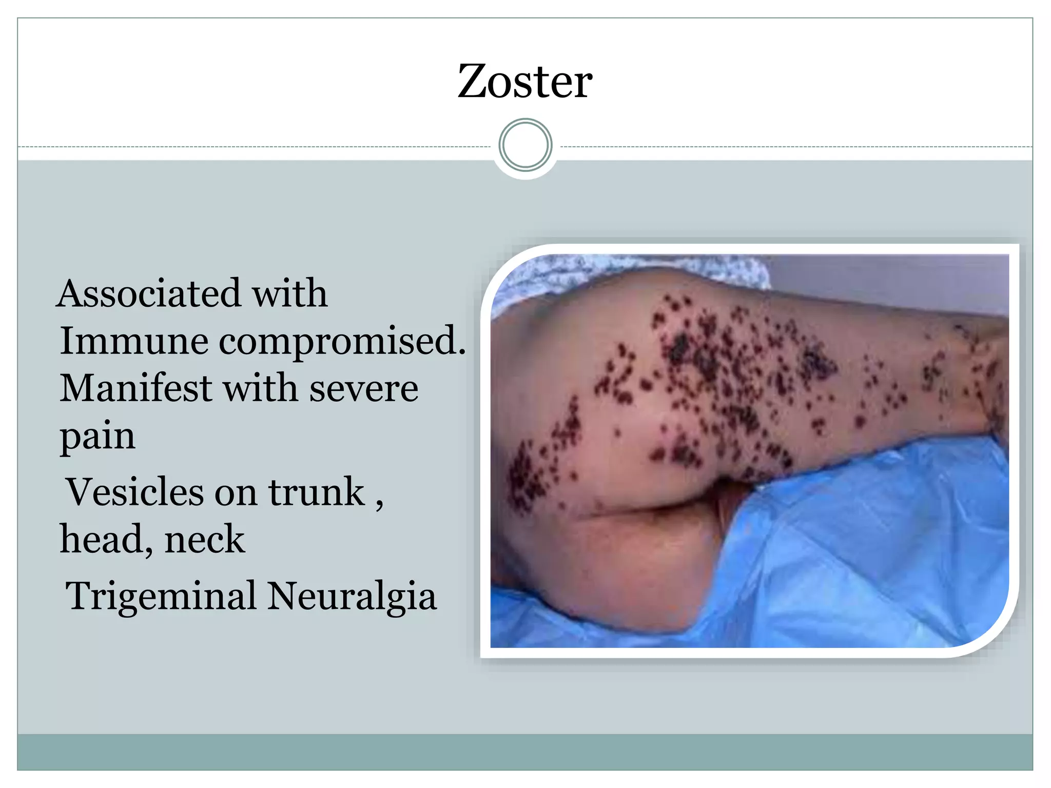 Varicella Zoster Virus Infections | PPTX