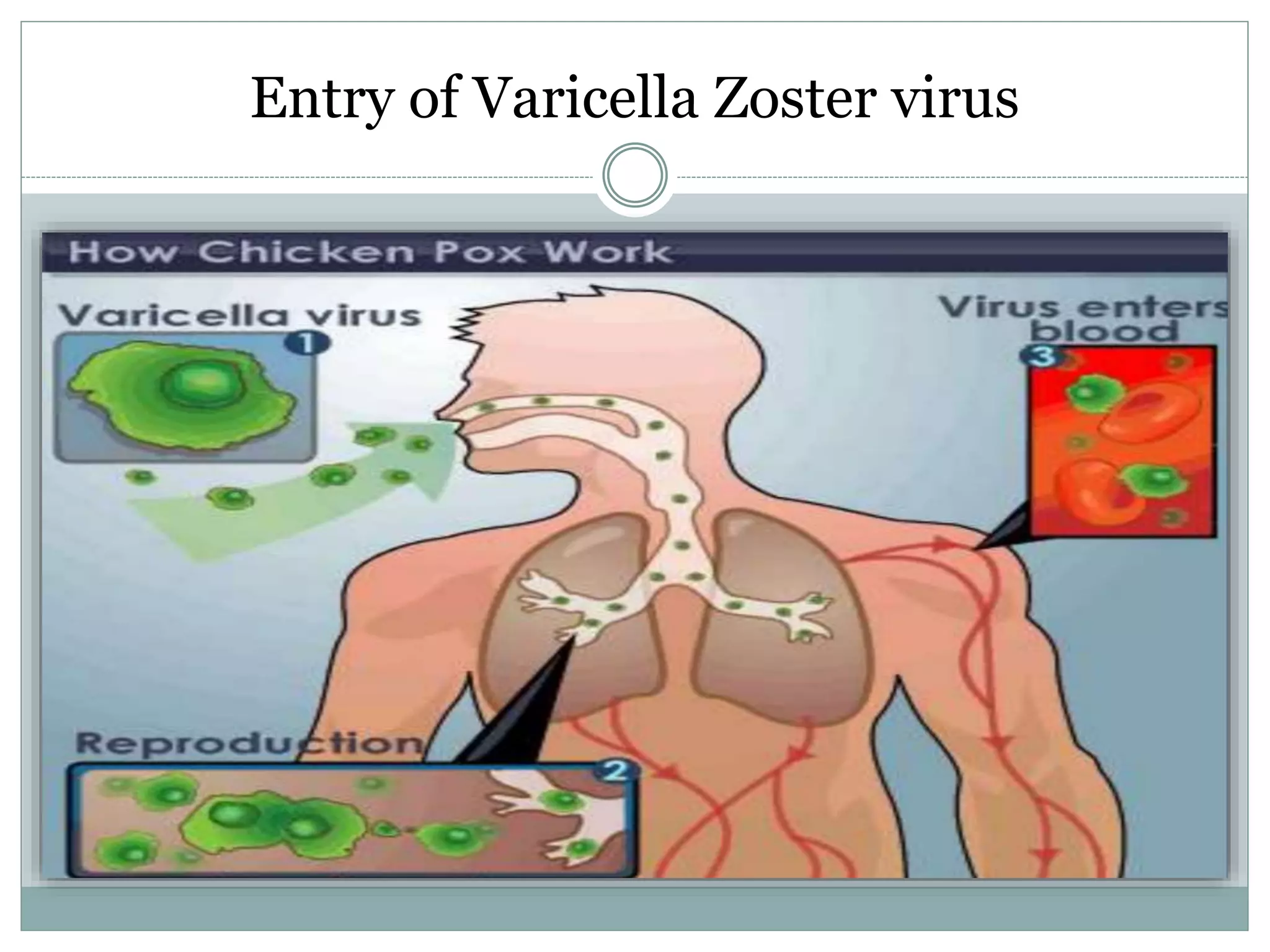 Varicella Zoster Virus Infections | PPTX