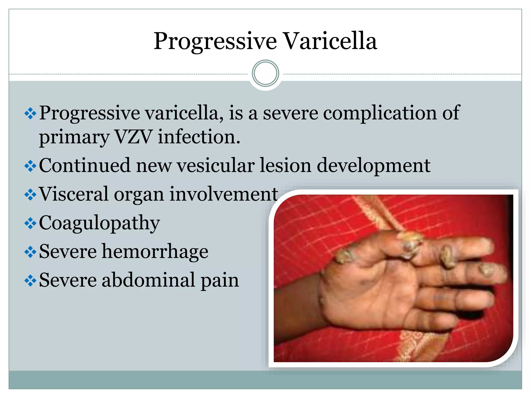 Varicella Zoster Virus Infections | PPTX