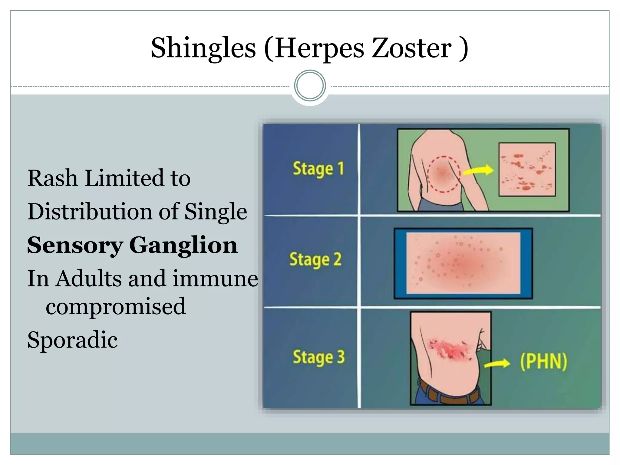 Varicella Zoster Virus Infections | PPTX