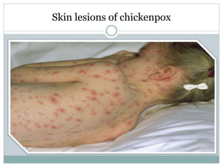 Varicella Zoster Virus Infections | PPTX