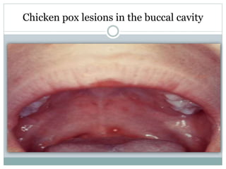 Varicella Zoster Virus Infections | PPTX