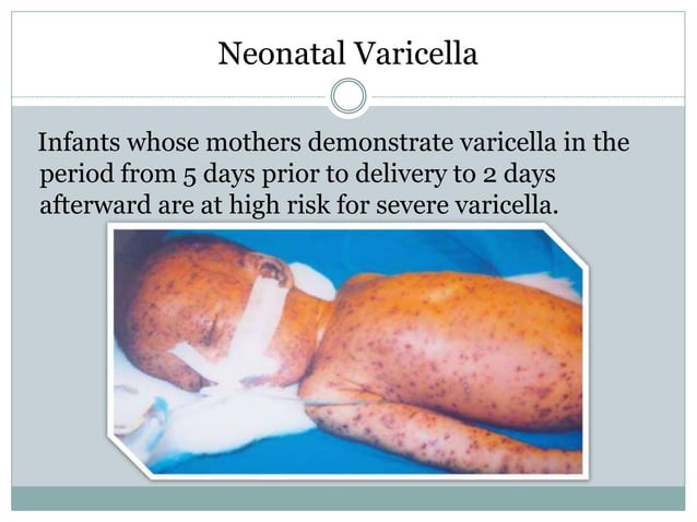 Varicella Zoster Virus Infections | PPTX