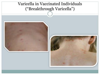 Breakthrough Chickenpox