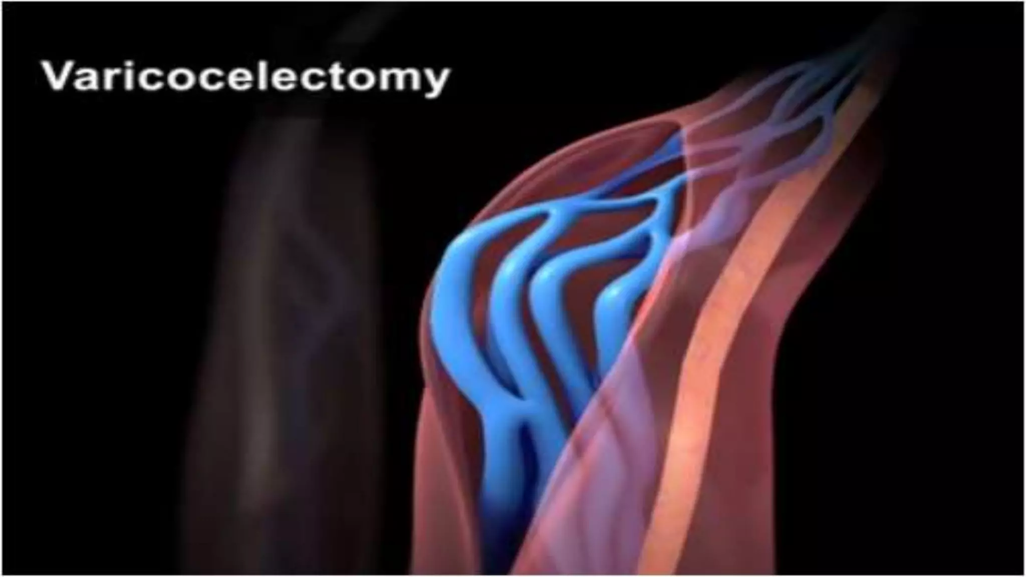 Varicocelectomy | PPTX