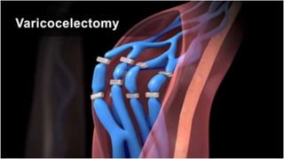 Varicocelectomy | PPTX