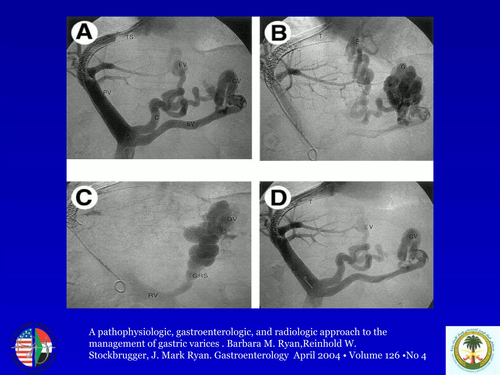 Variceal Bleeding | PPT