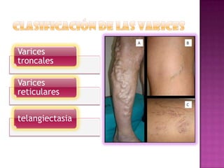 Varices etiologia y etiopatogenia | PPTX