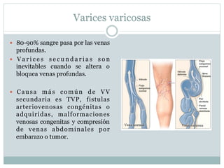 Varices varicosas | PDF