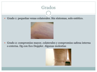 Varices varicosas | PDF