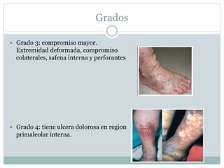 Varices varicosas | PDF