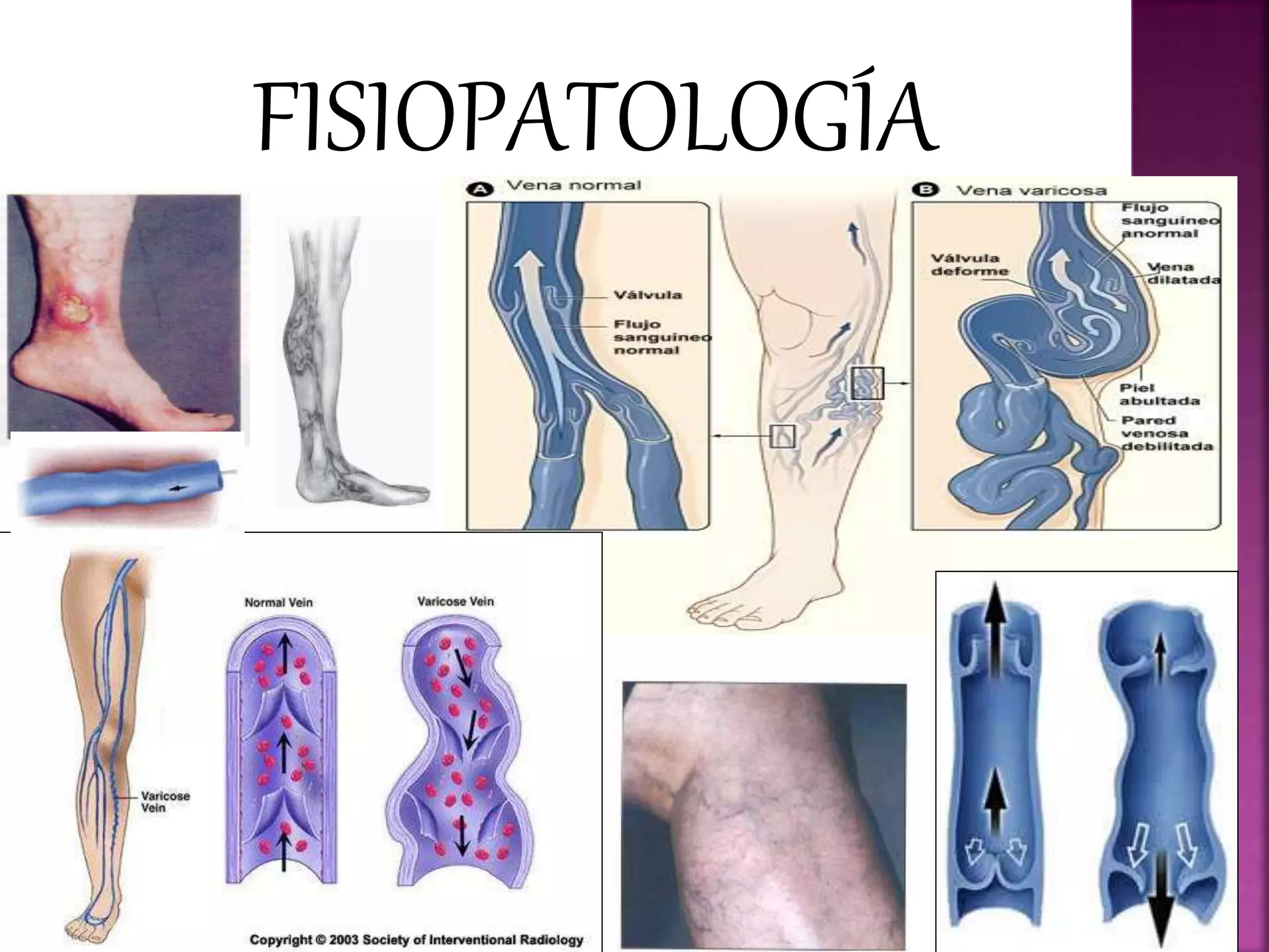 VARICES FISIOPATOLOGIA | PPTX