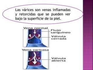 VARICES FISIOPATOLOGIA | PPTX