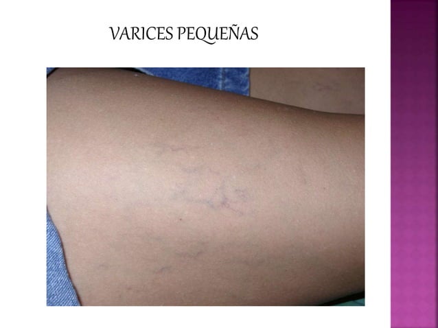 VARICES FISIOPATOLOGIA | PPTX