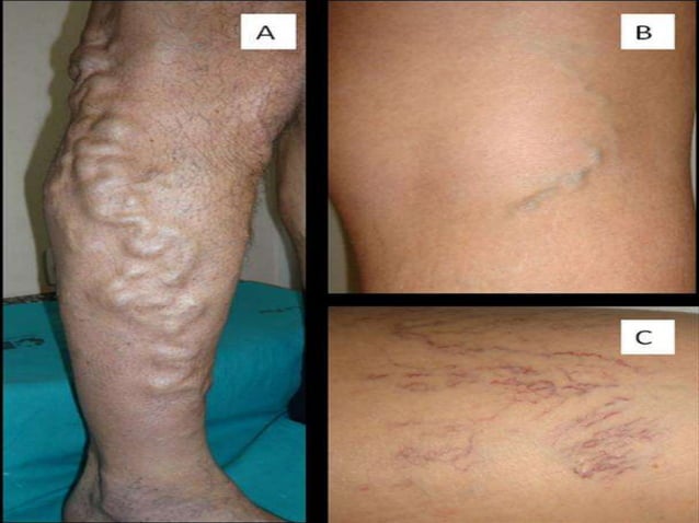 VARICES FISIOPATOLOGIA | PPTX