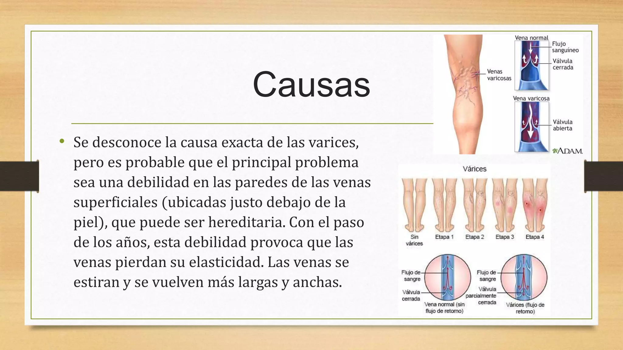 Varices.pptx
