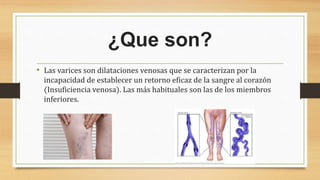 Varices.pptx