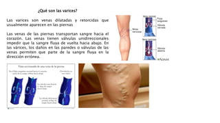 Varices que son por qué aparecen y su tratamiento.pptx