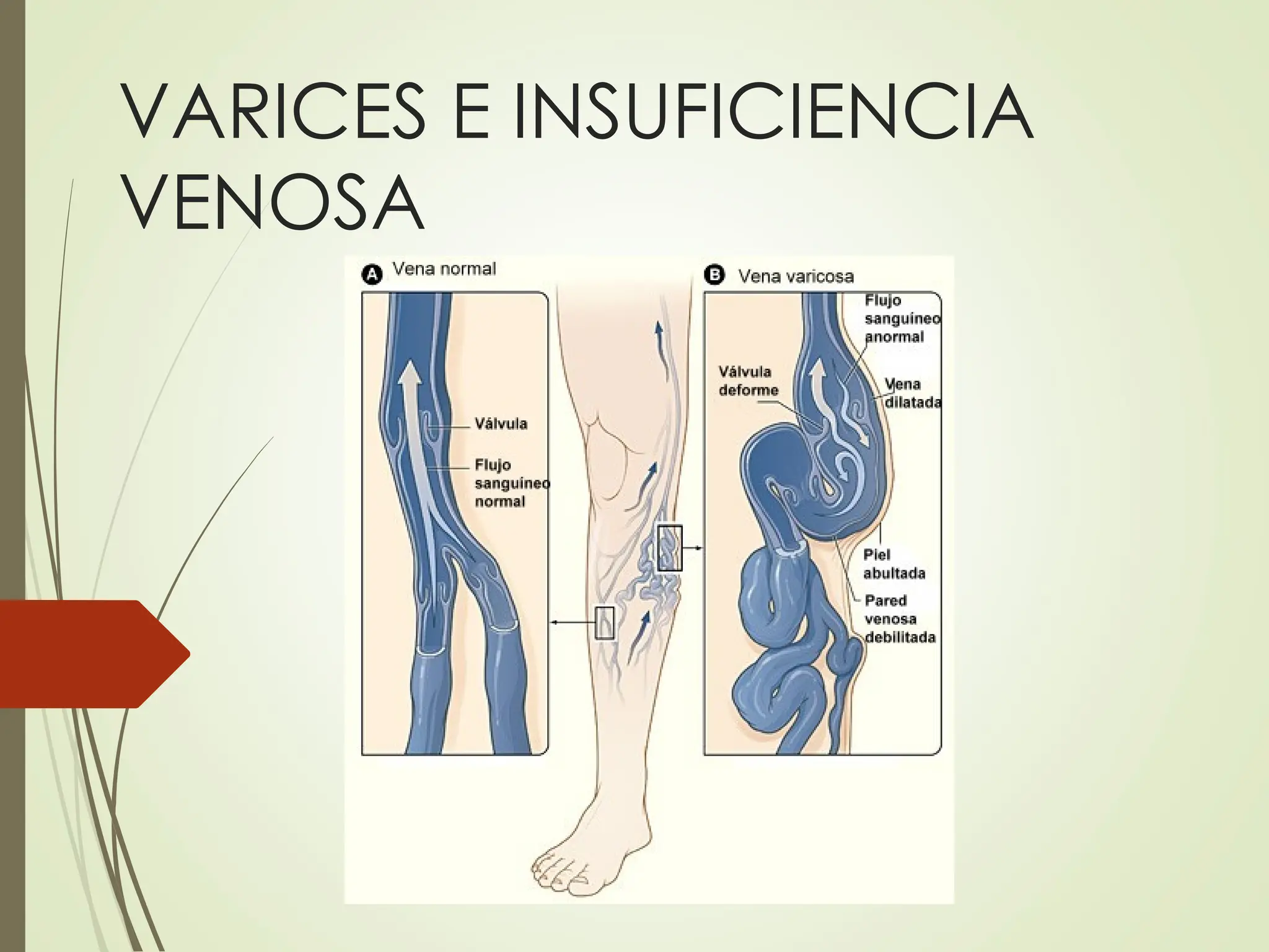 varices-e-insuficiencia-venosa cronica.ppt