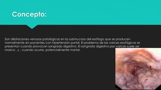 Varices esofagicas | PPTX