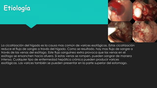 Varices esofagicas | PPTX