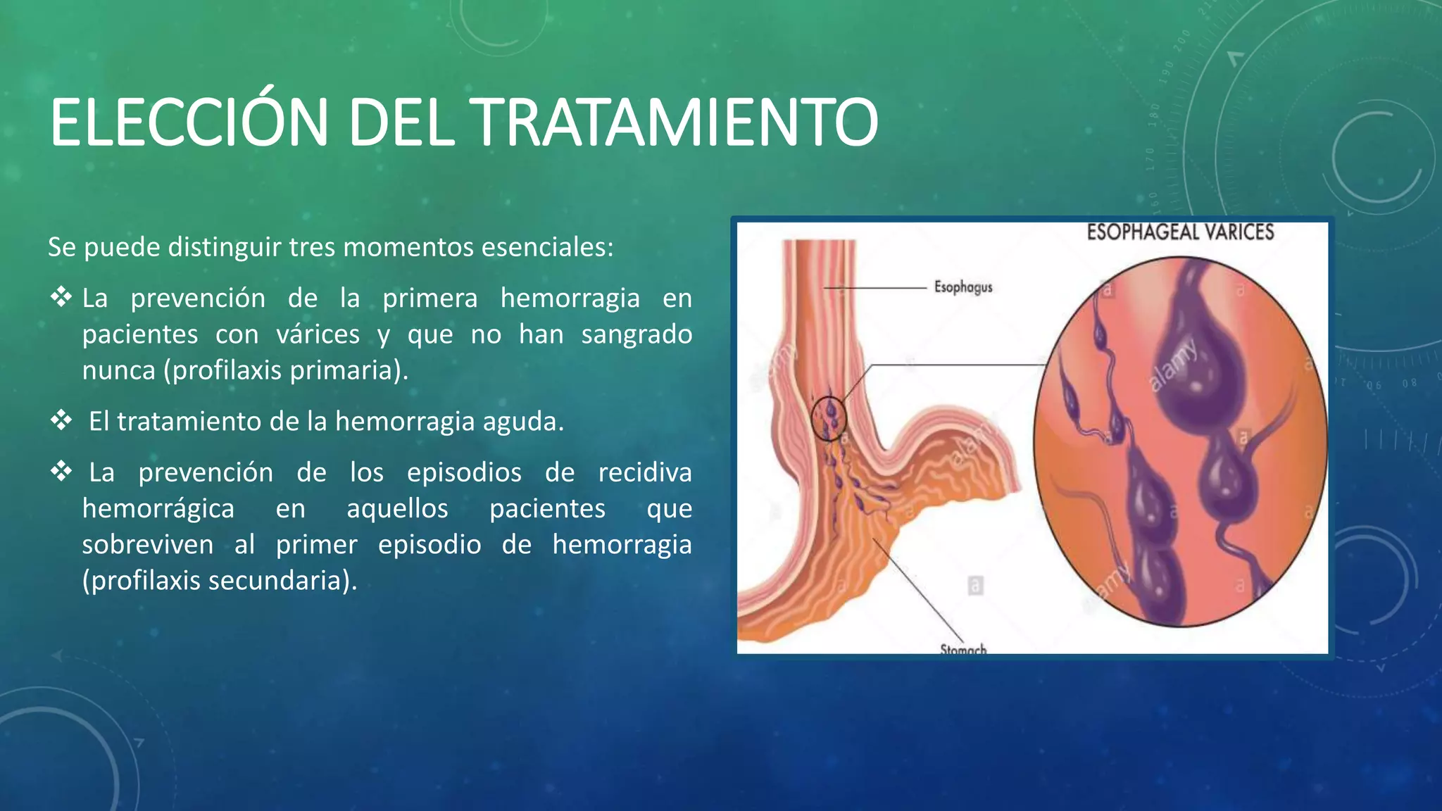 Varices esofagicas | PPTX