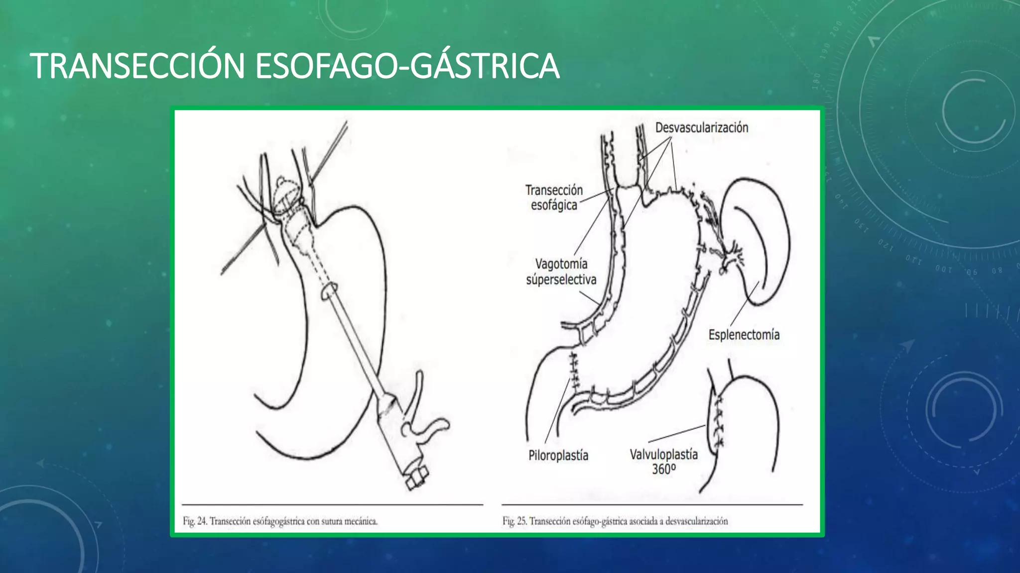 Varices esofagicas | PPTX