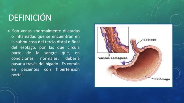 Varices esofagicas | PPTX