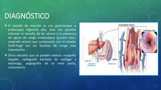 Varices esofagicas | PPTX