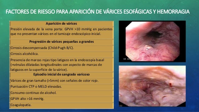 Varices esofagicas